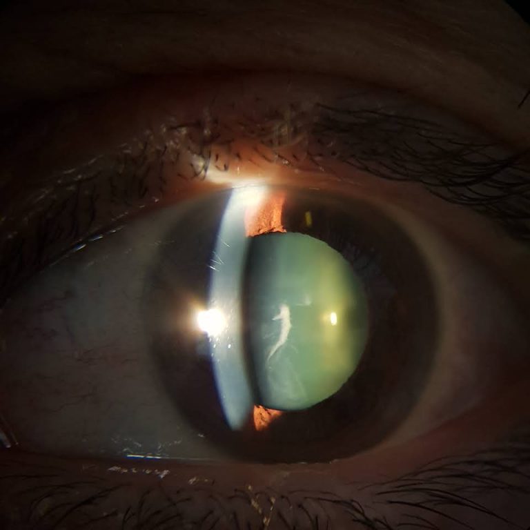 Cataratta immagini - Immagini di cataratte - Medicioculisti.it